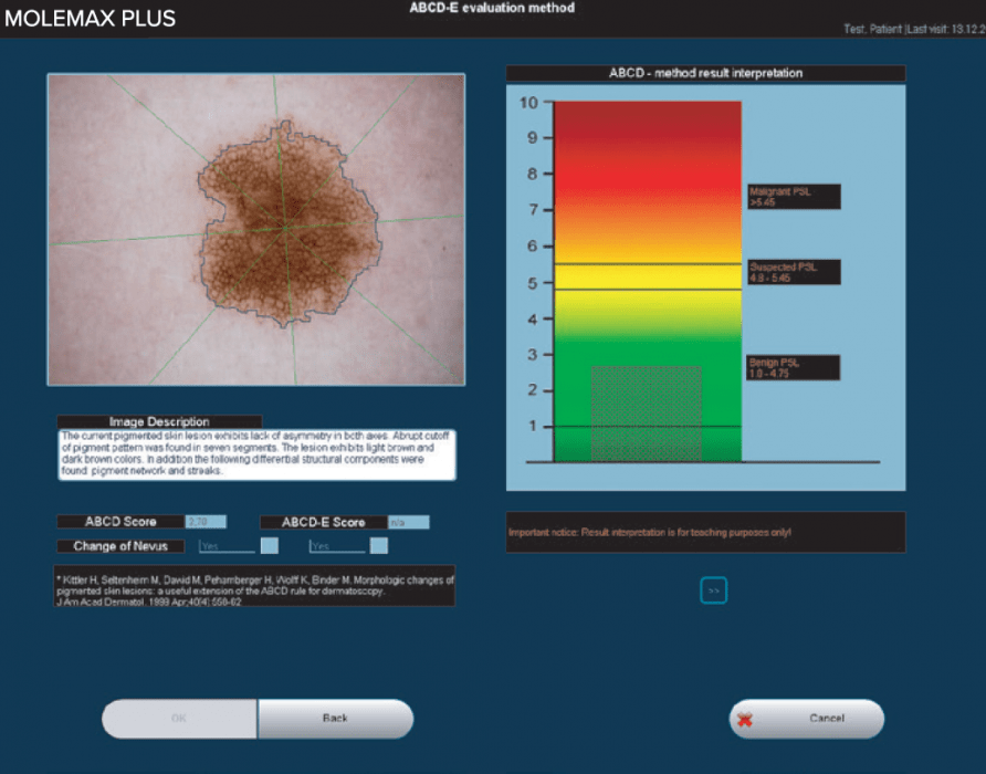 Product | MoleMax Plus - MoleMax Systems