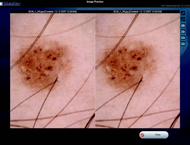PhotoMax Pro Kit - MoleMax Systems